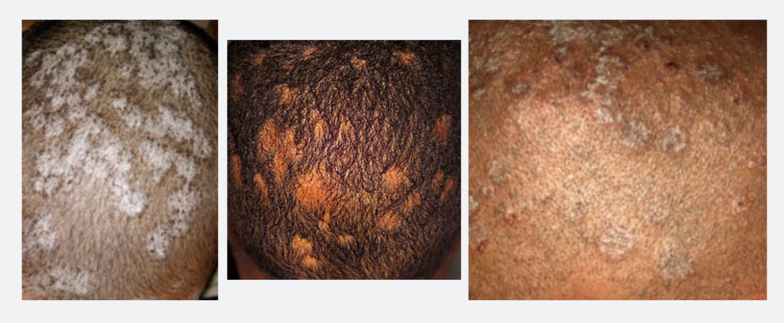 Tinea Capitis – Ringworm of the scalp – IMITHI YESINTU